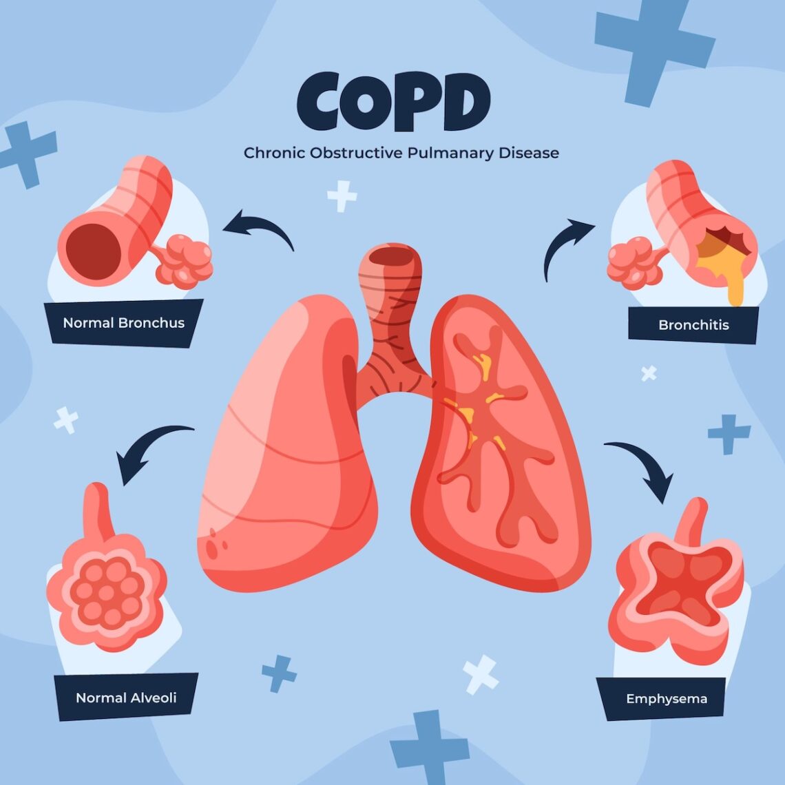 Chronic Obstructive Pulmonary Disease (COPD): Causes, Symptoms ...