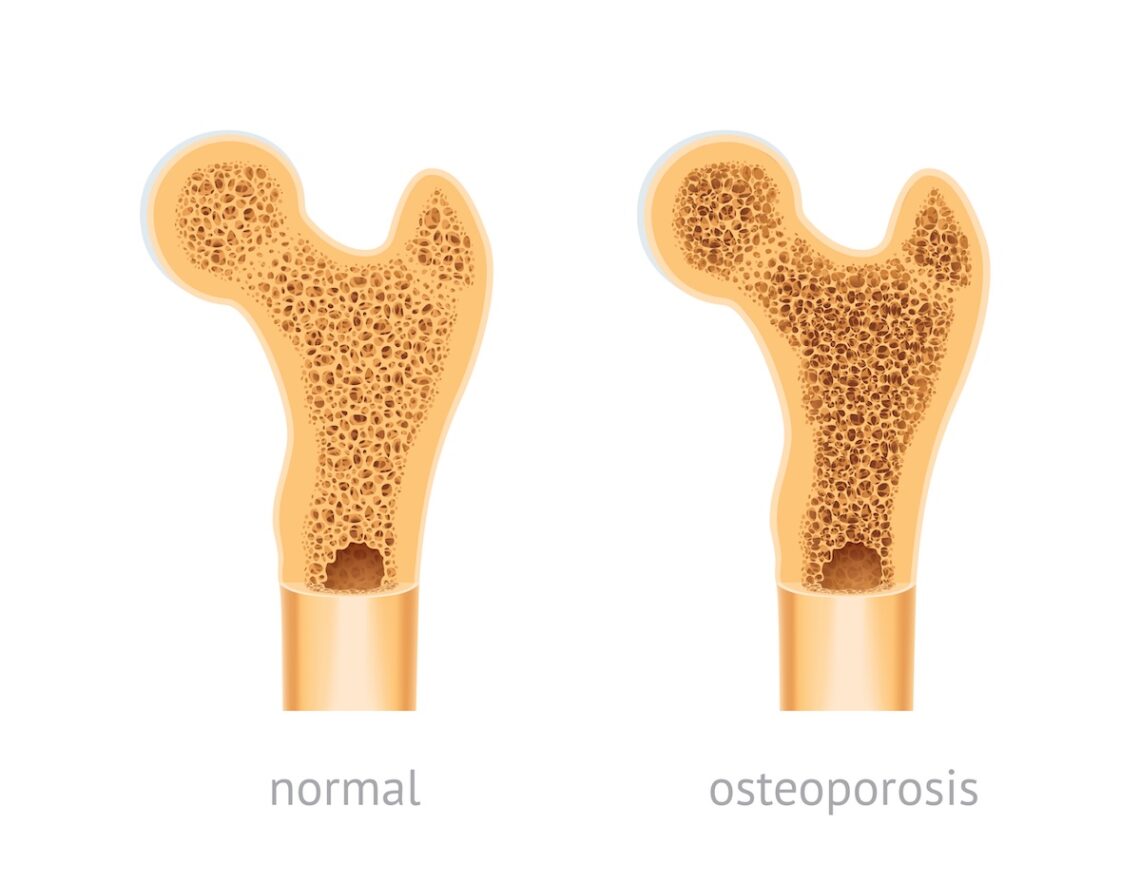 Understanding Osteoporosis: Causes, Symptoms, Diagnosis, and Treatment